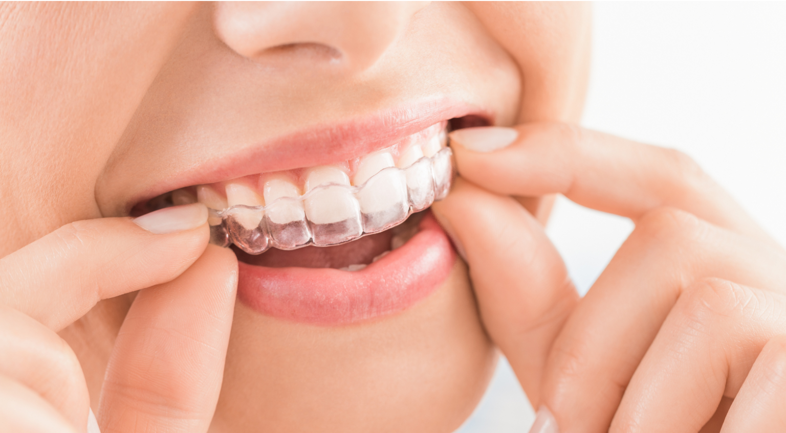 Comparing Aligners: Spark, Invisalign, SureSmile, and Angel Aligner ...